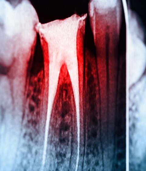 Root Canals - Fleetwood Park Dental Centre